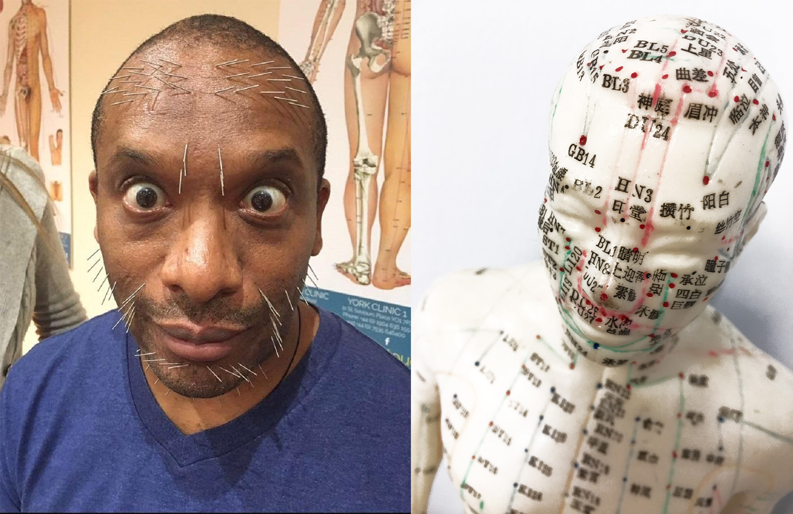 Try Acupuncture | Touch Tuina